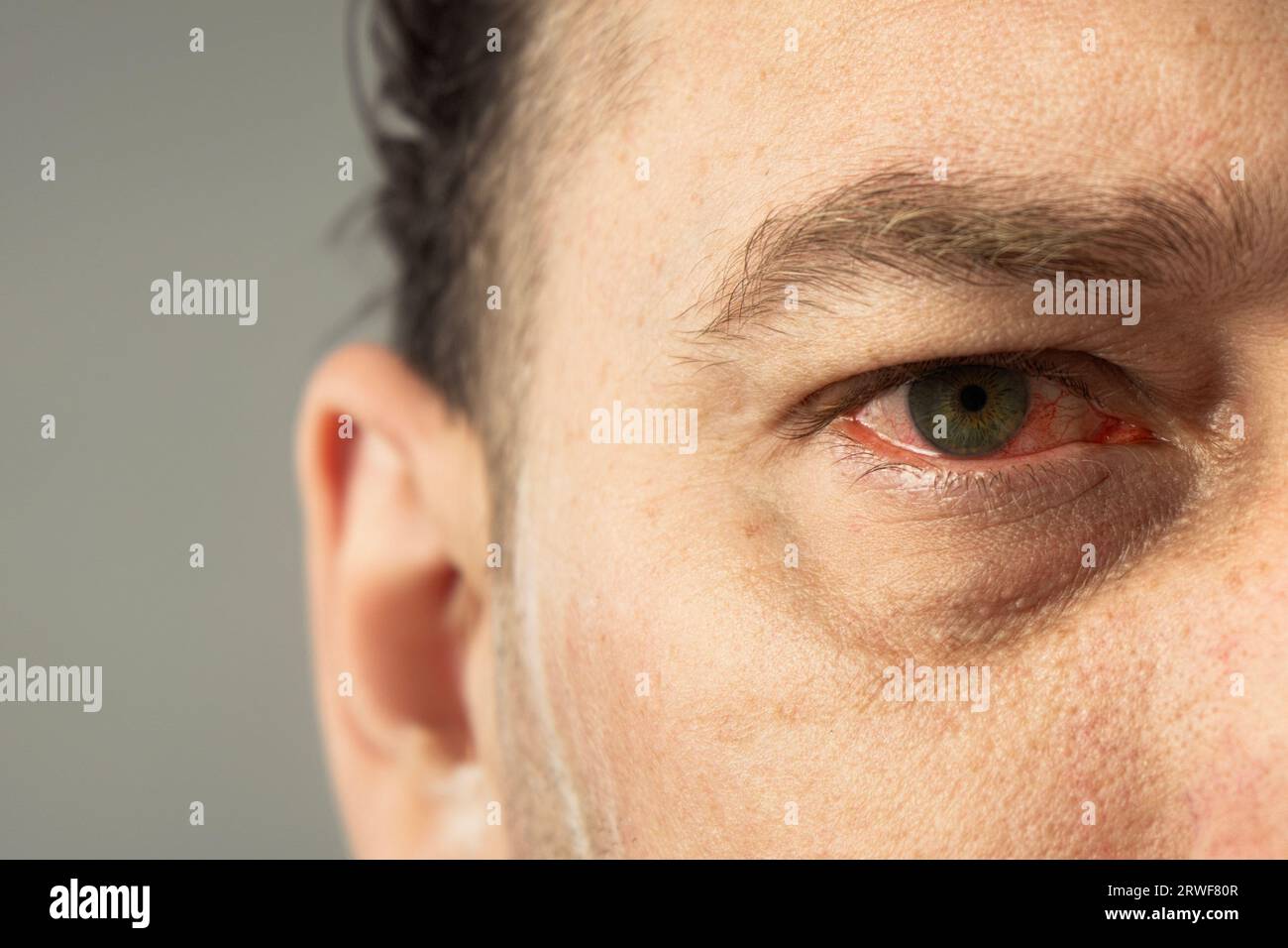 Red eye in a person. A close-up of a heavily bloodshot eye. Ophthalmia ...