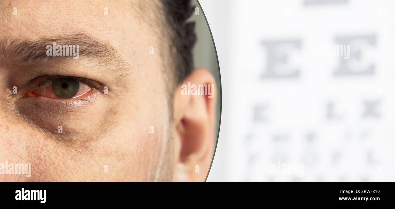 Red eye in a person. A close-up of a heavily bloodshot eye. Ophthalmia ...