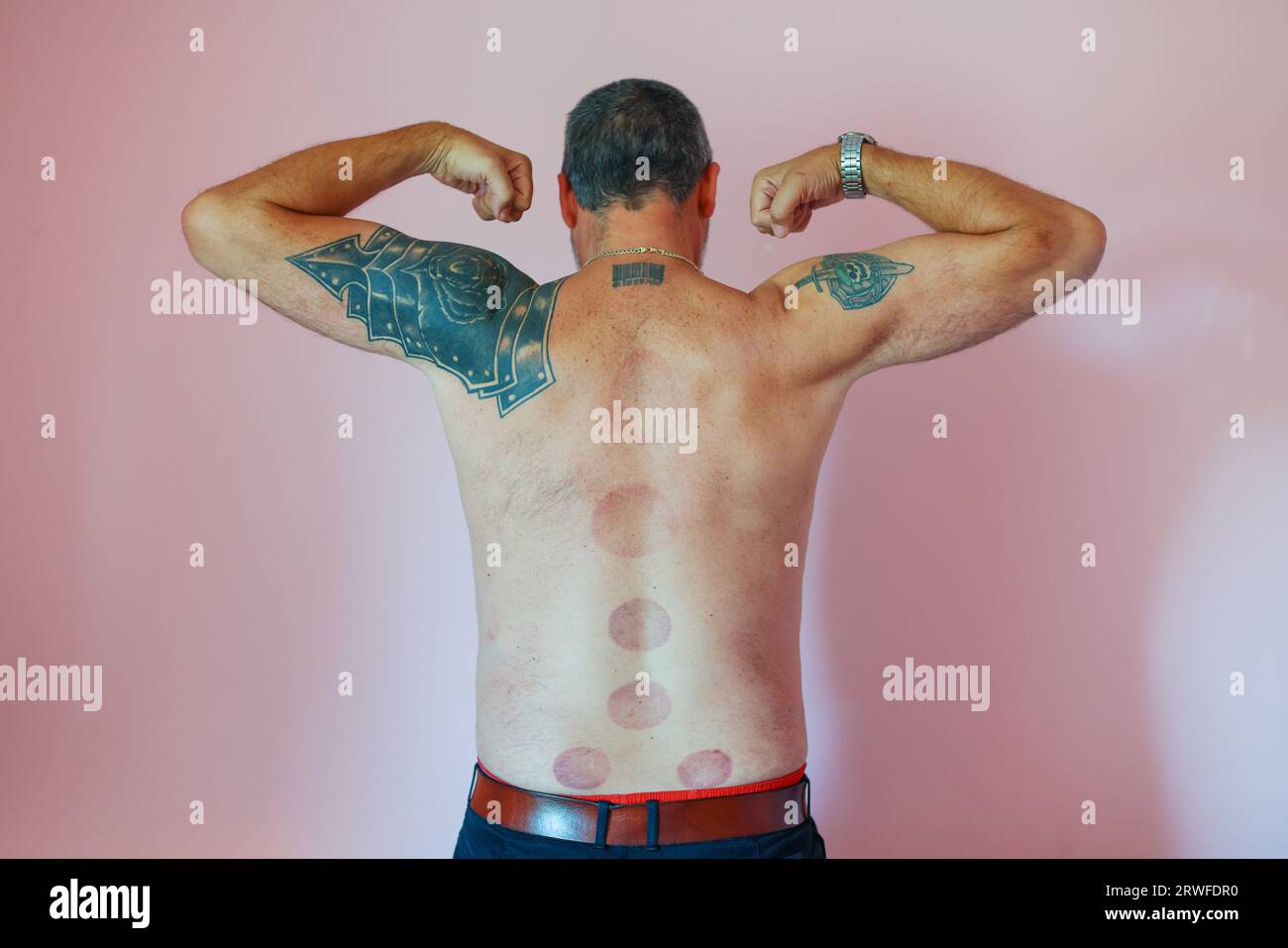 Cupping marks hi-res stock photography and images - Alamy