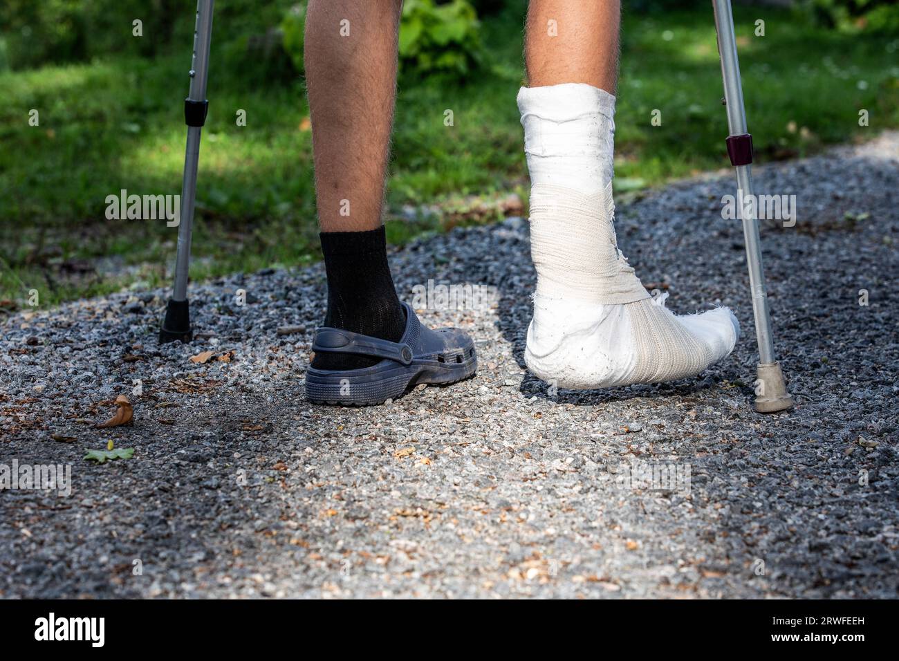 Broken ankle and a leg cast. Leg splint Stock Photo - Alamy