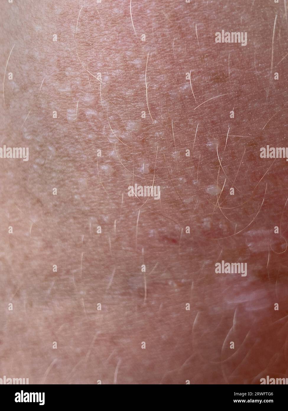 Close up on blistered skin damaged by sun exposure Stock Photo - Alamy