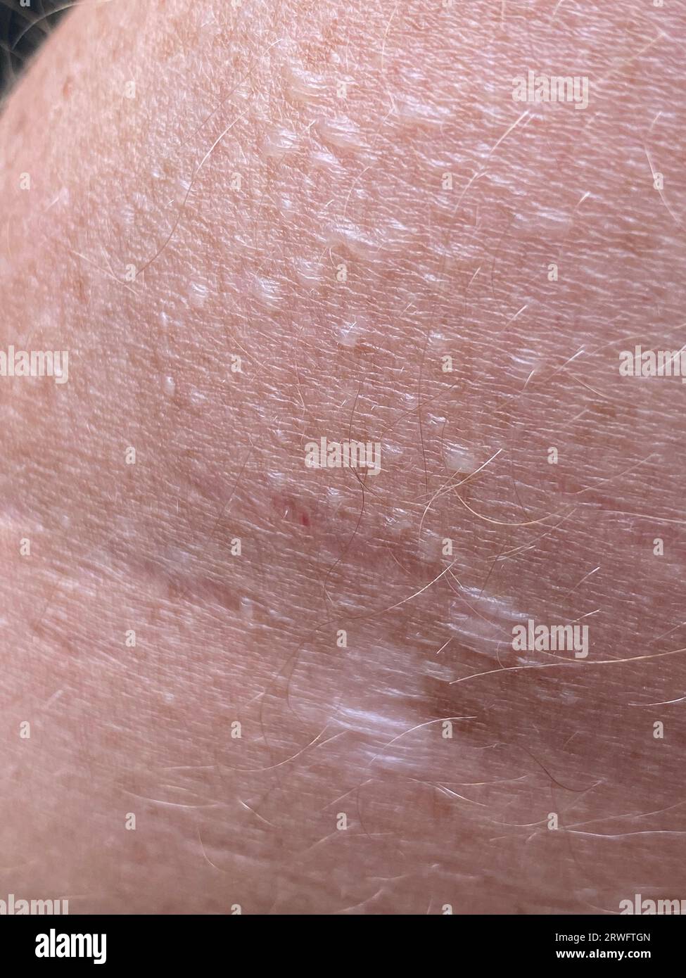 Close up on blistered skin damaged by sun exposure Stock Photo - Alamy