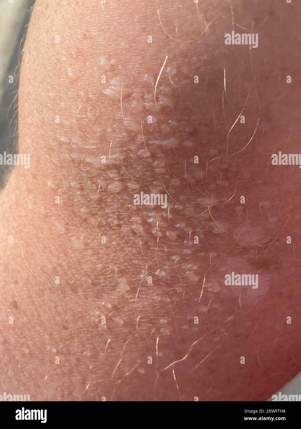 Close up on blistered skin damaged by sun exposure Stock Photo - Alamy