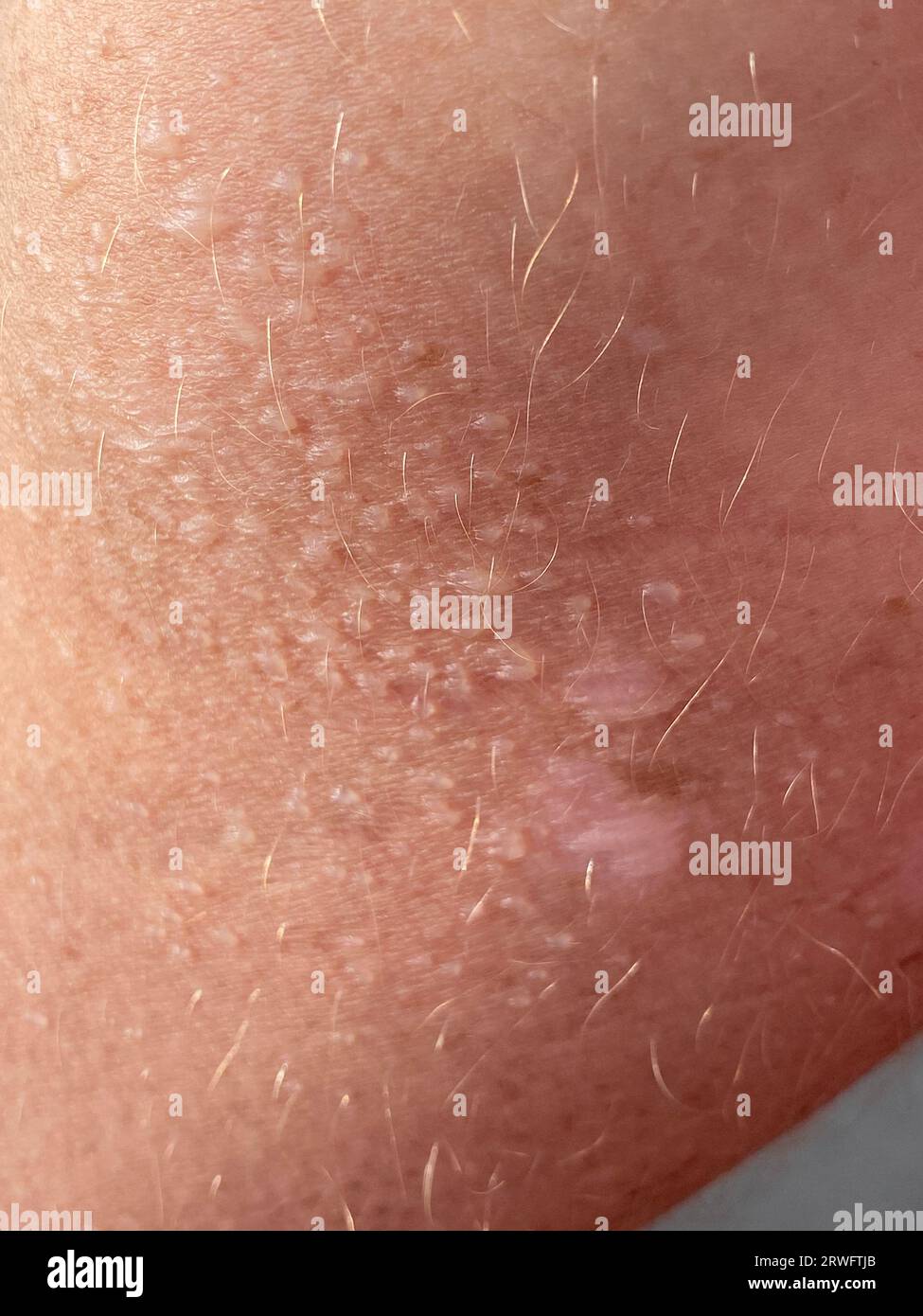 Close up on blistered skin damaged by sun exposure Stock Photo - Alamy