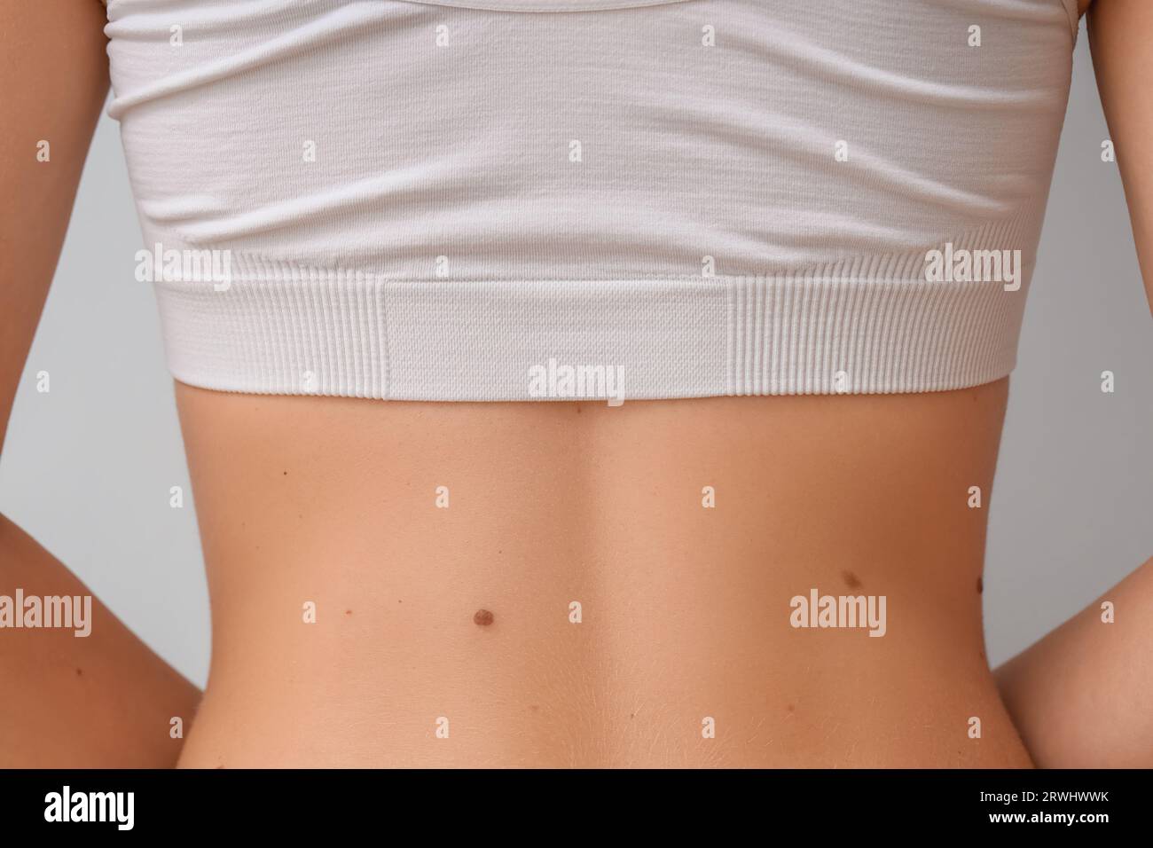 Moles on back skin cancer hi-res stock photography and images - Alamy