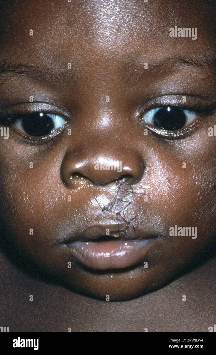 Child with repaired cleft lip Stock Photo - Alamy
