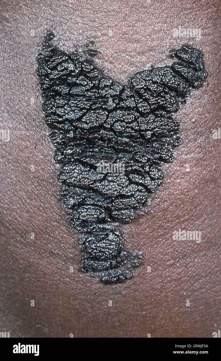 Verrucous epidermal nevus syndrome Stock Photo - Alamy