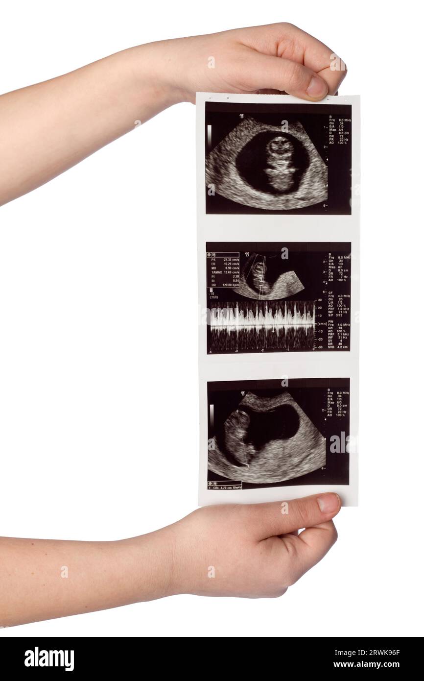 Hands holding ultrasound scans of a baby isolated on white background ...