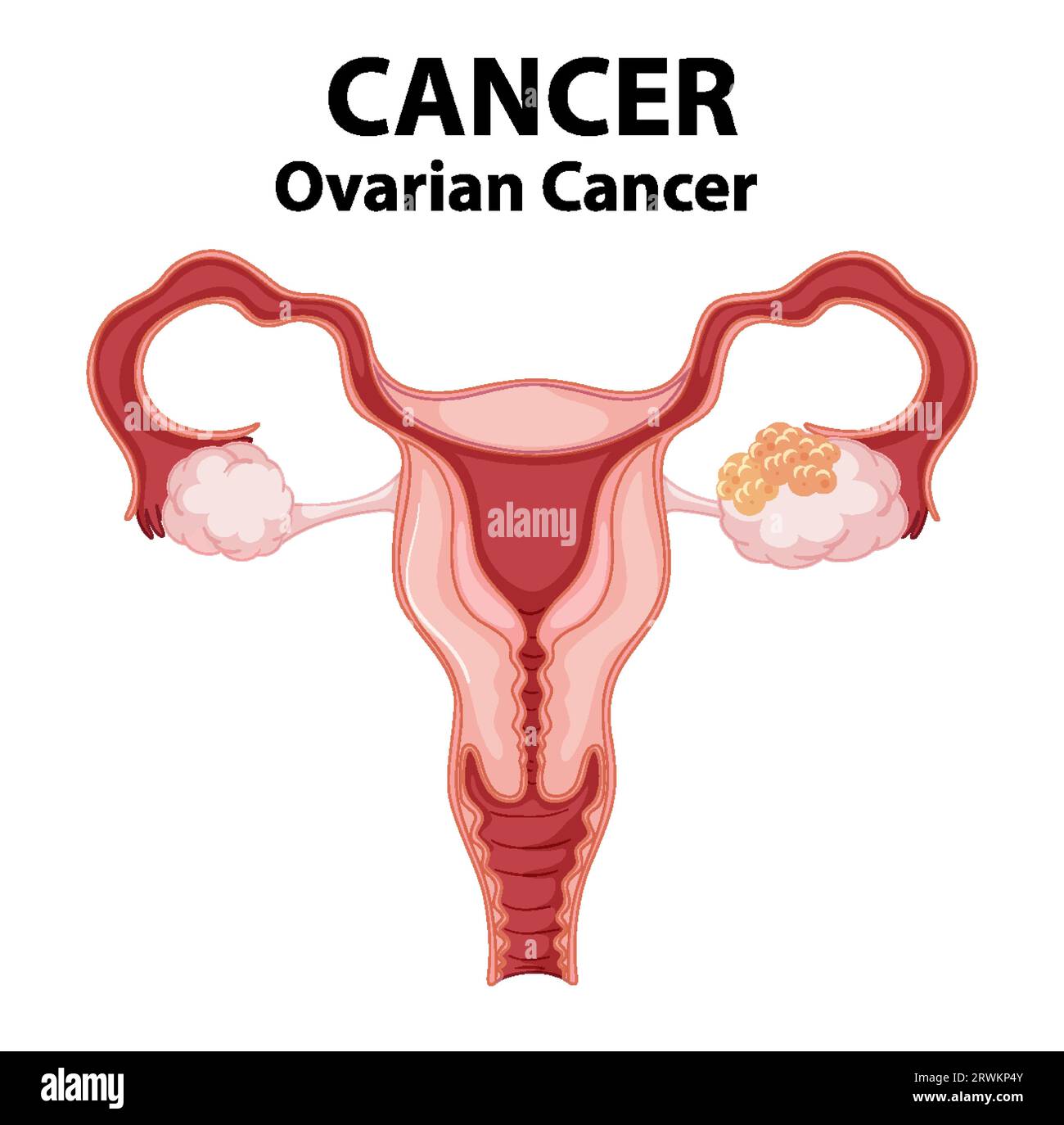 An informative infographic illustrating the differences between healthy and cancerous ovaries in ...