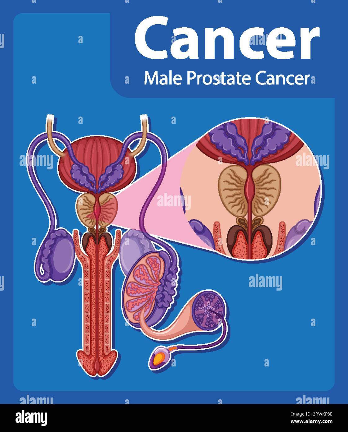 Infographic Illustrating Abnormal Cell Growth In Male Prostate Cancer