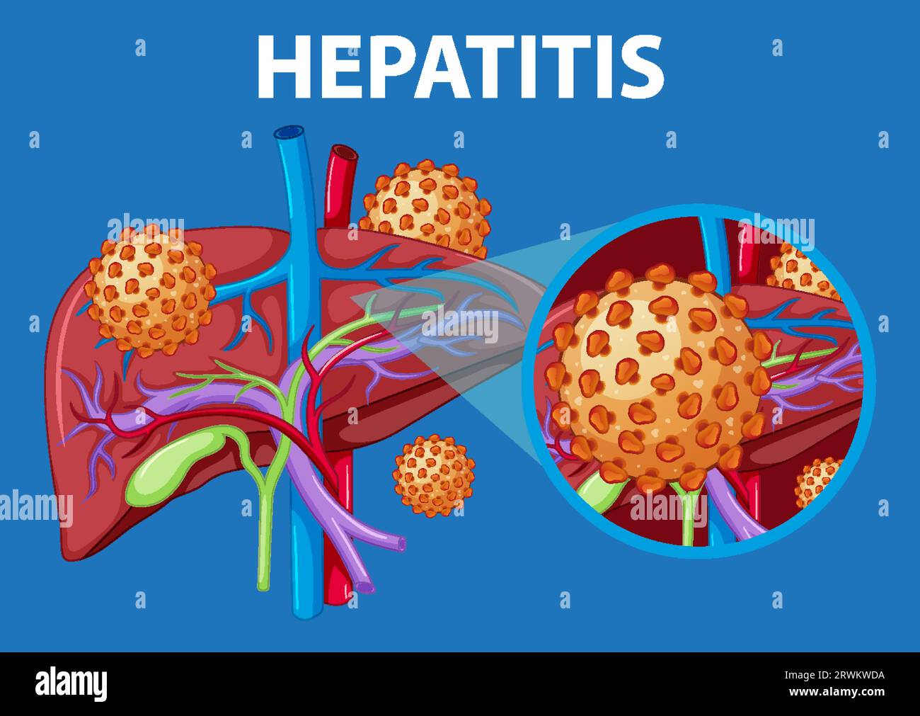 Illustration depicting the anatomy of a liver affected by hepatitis ...