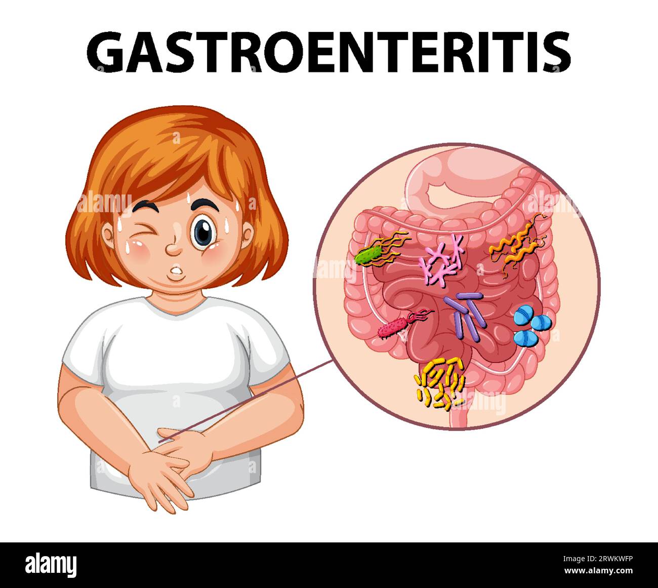 Illustration of a woman suffering from gastroenteritis due to infection ...