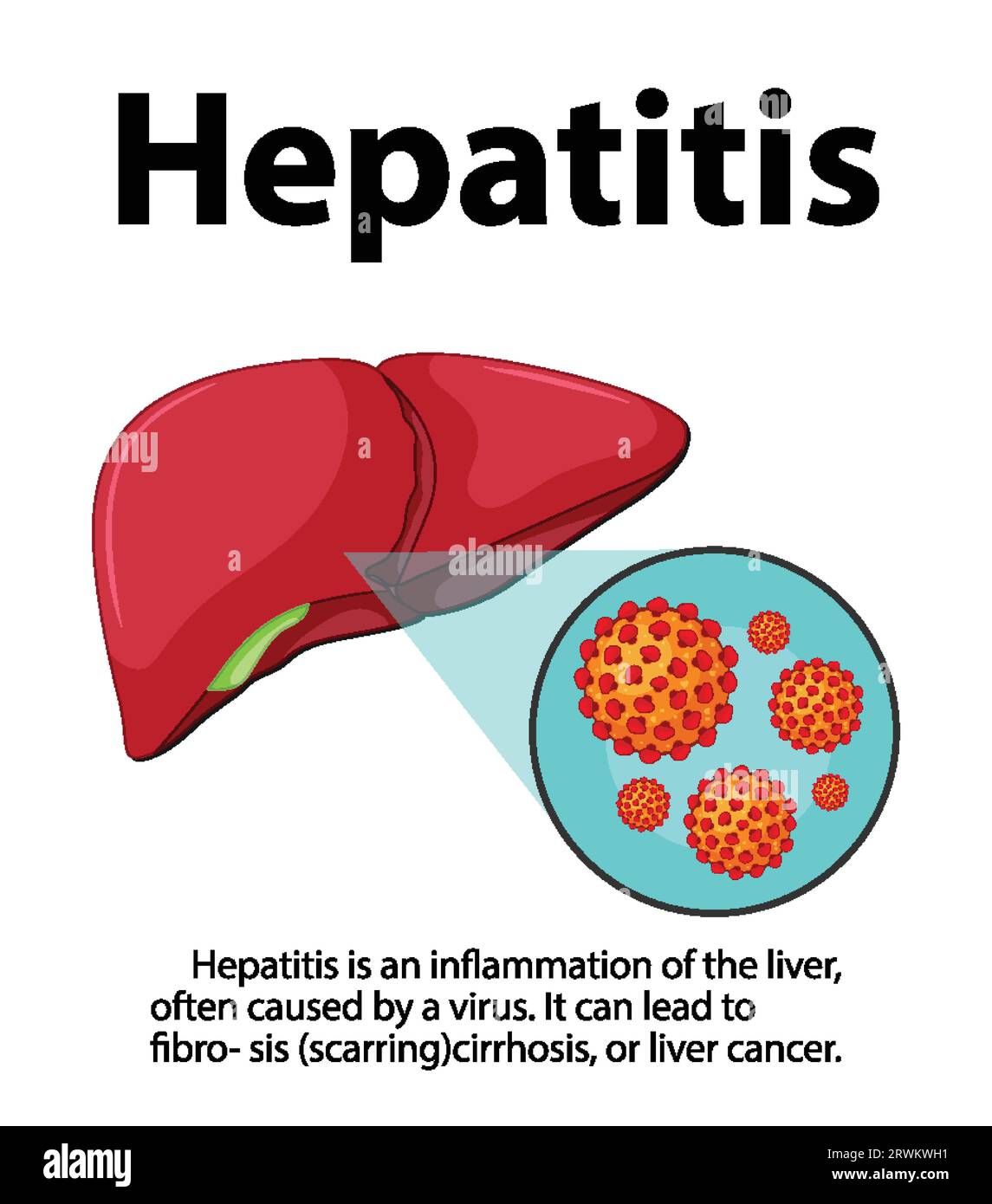 Detailed illustration showing the hepatitis virus cell on human liver ...