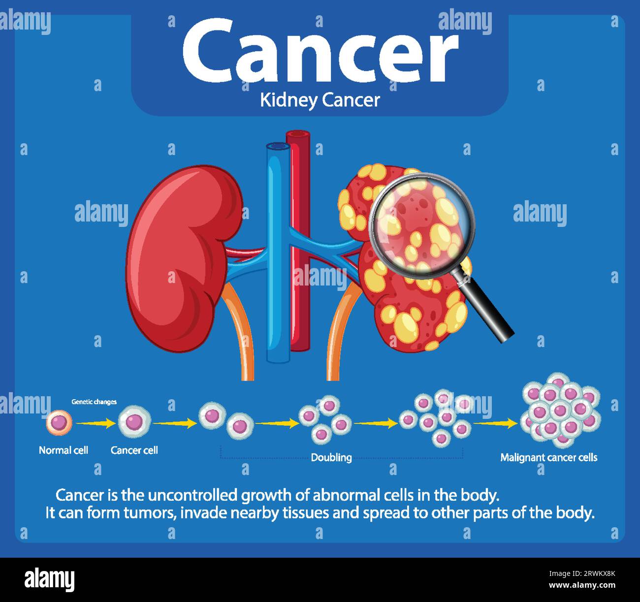 Illustrated infographic depicting the process of cancer development in ...