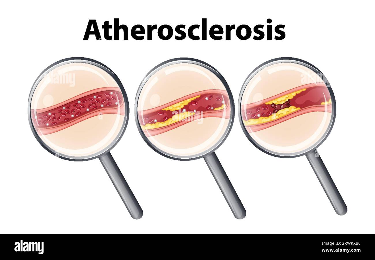 Infographic on heart health and cardiovascular disease risks Stock ...