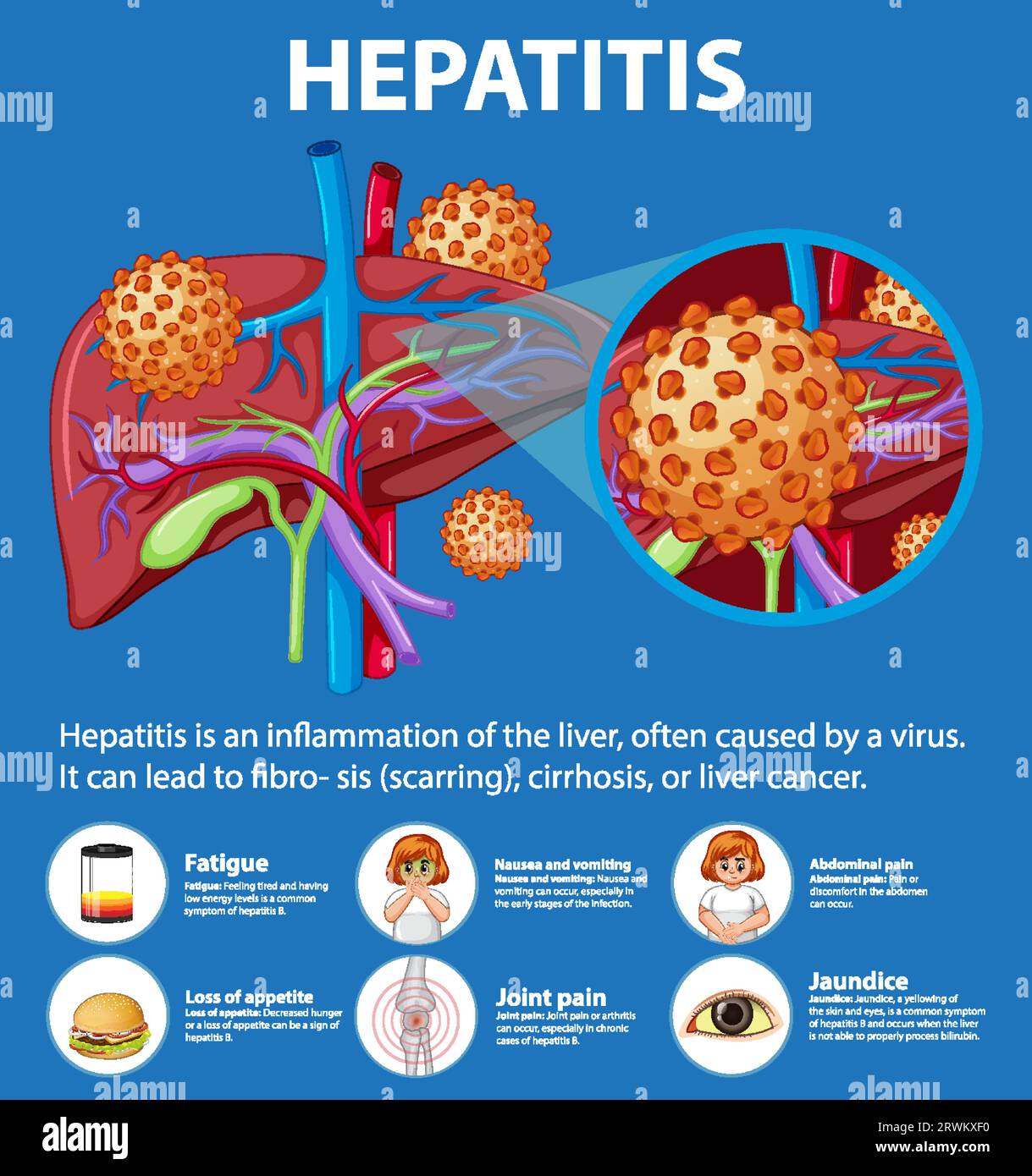 Illustration depicting the effects of hepatitis on the human liver ...