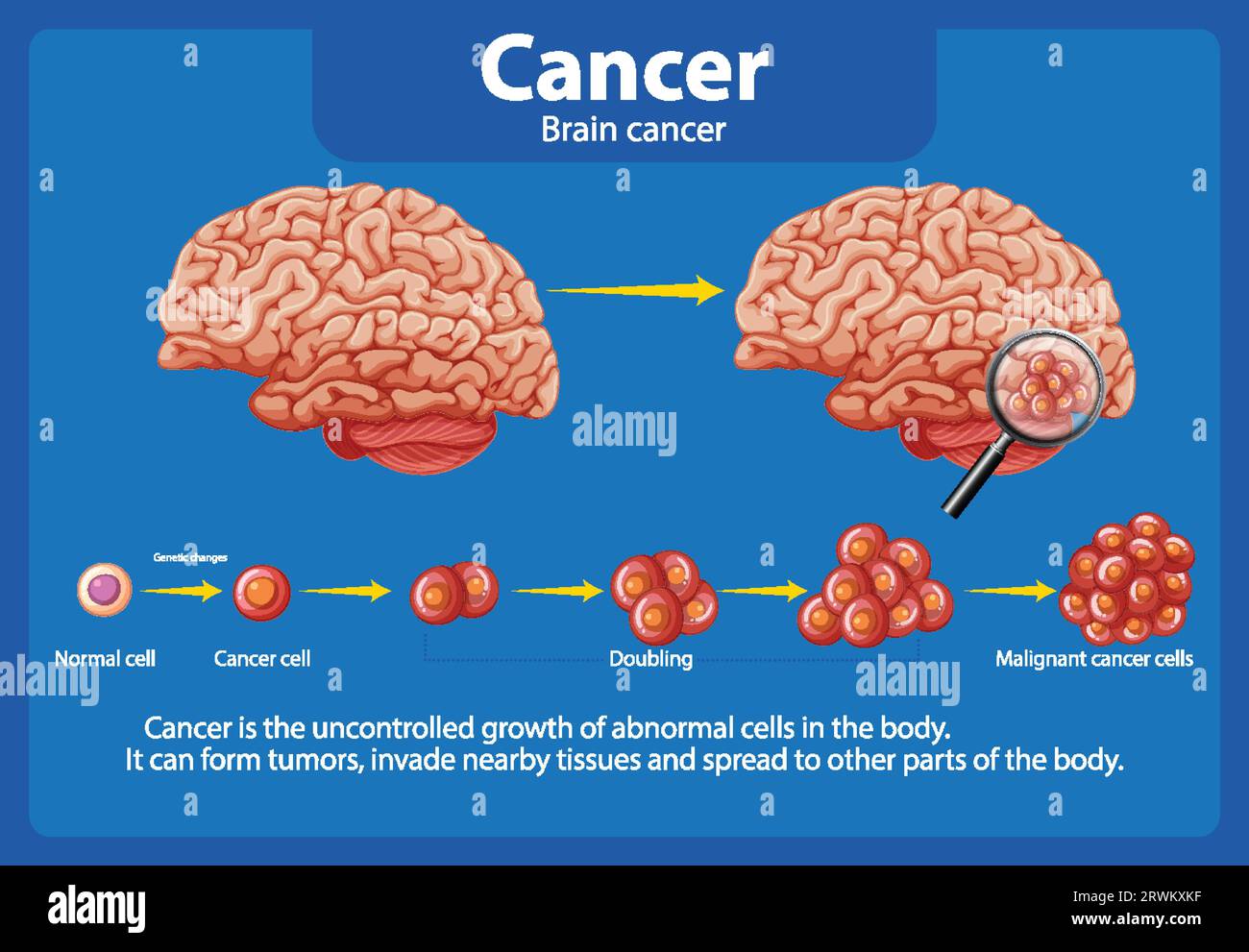 Illustrated guide to brain cancer and abnormal cell growth Stock Vector Image & Art - Alamy