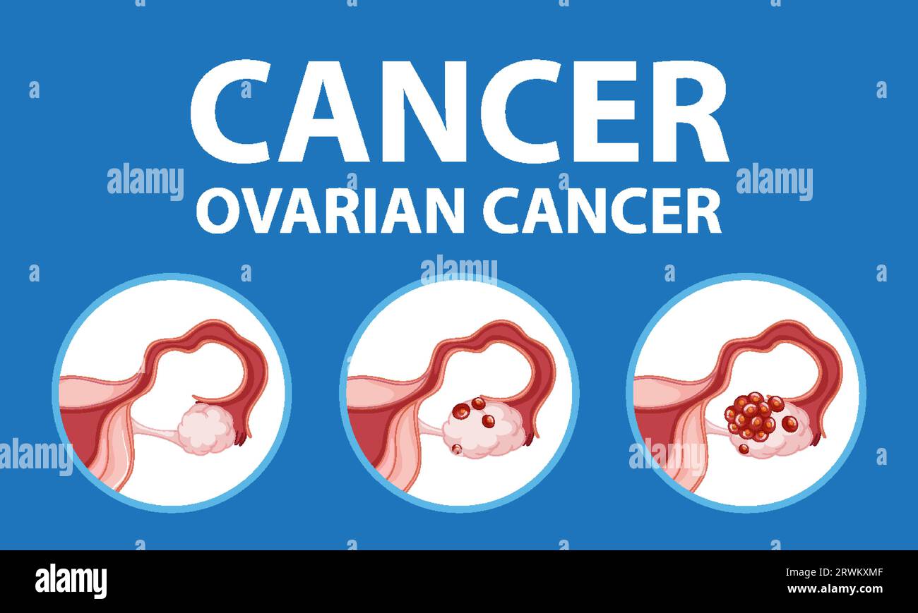 Visual representation of different stages of ovarian cancer in women ...