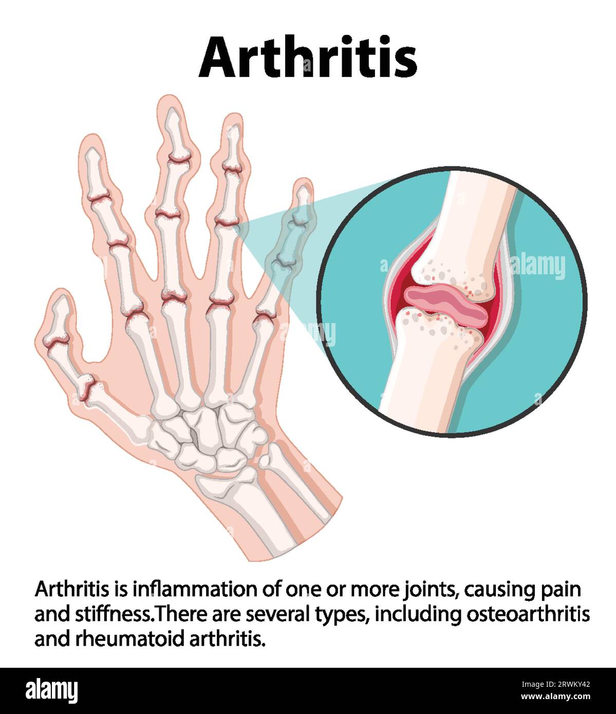 Learn about human anatomy and arthritis stages through an informative ...