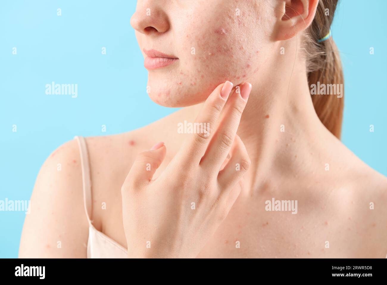 Teenage girl with acne problem on blue background, closeup Stock Photo ...