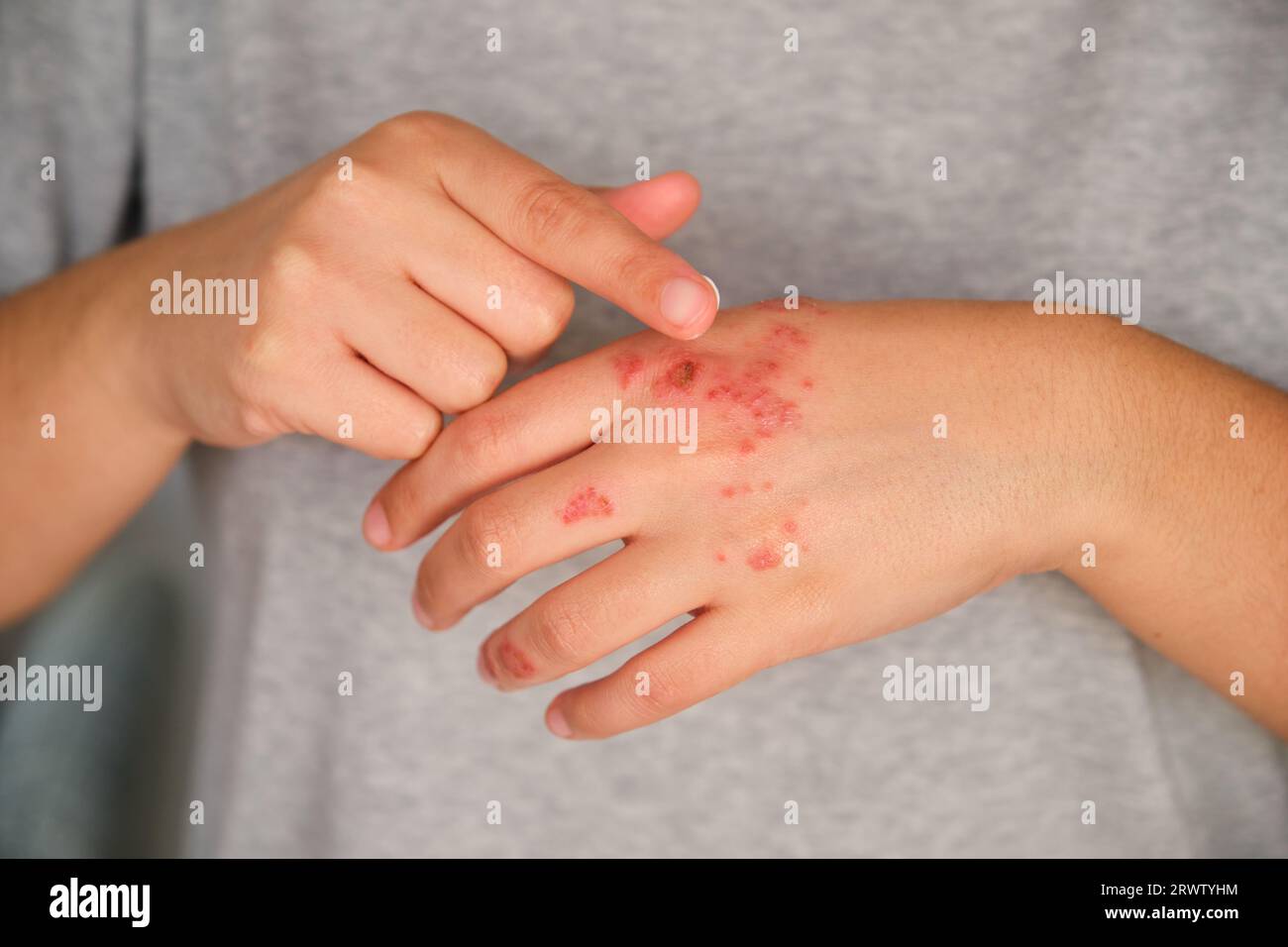 Patient hands applying ointment cream on eczema Stock Photo - Alamy