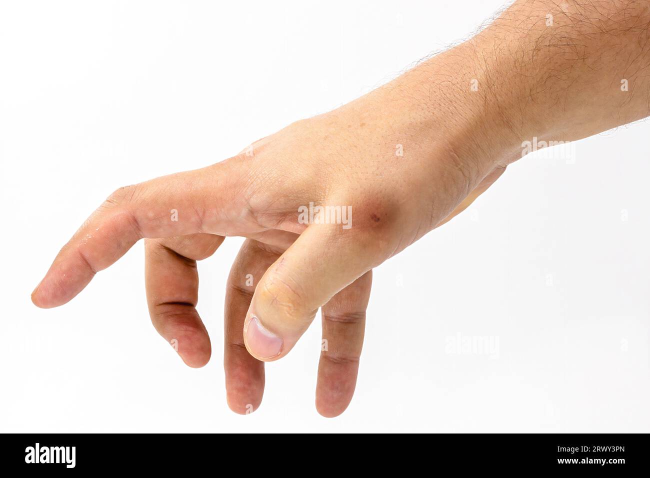 male hand, dry and with skin spots, dermatological problem, solar ...