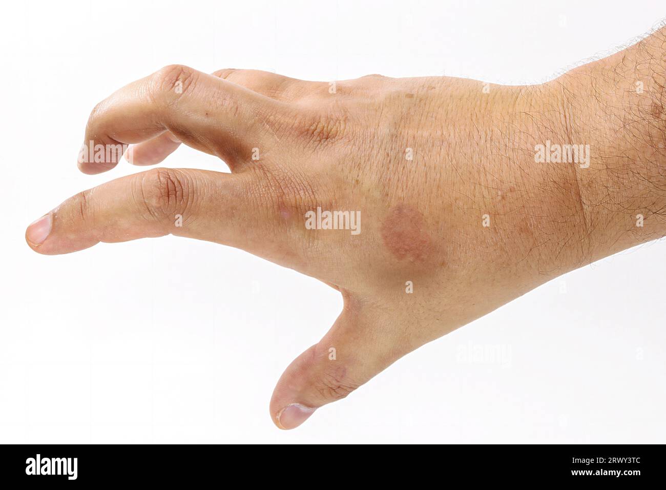 male hand, dry and with skin spots, dermatological problem, solar ...