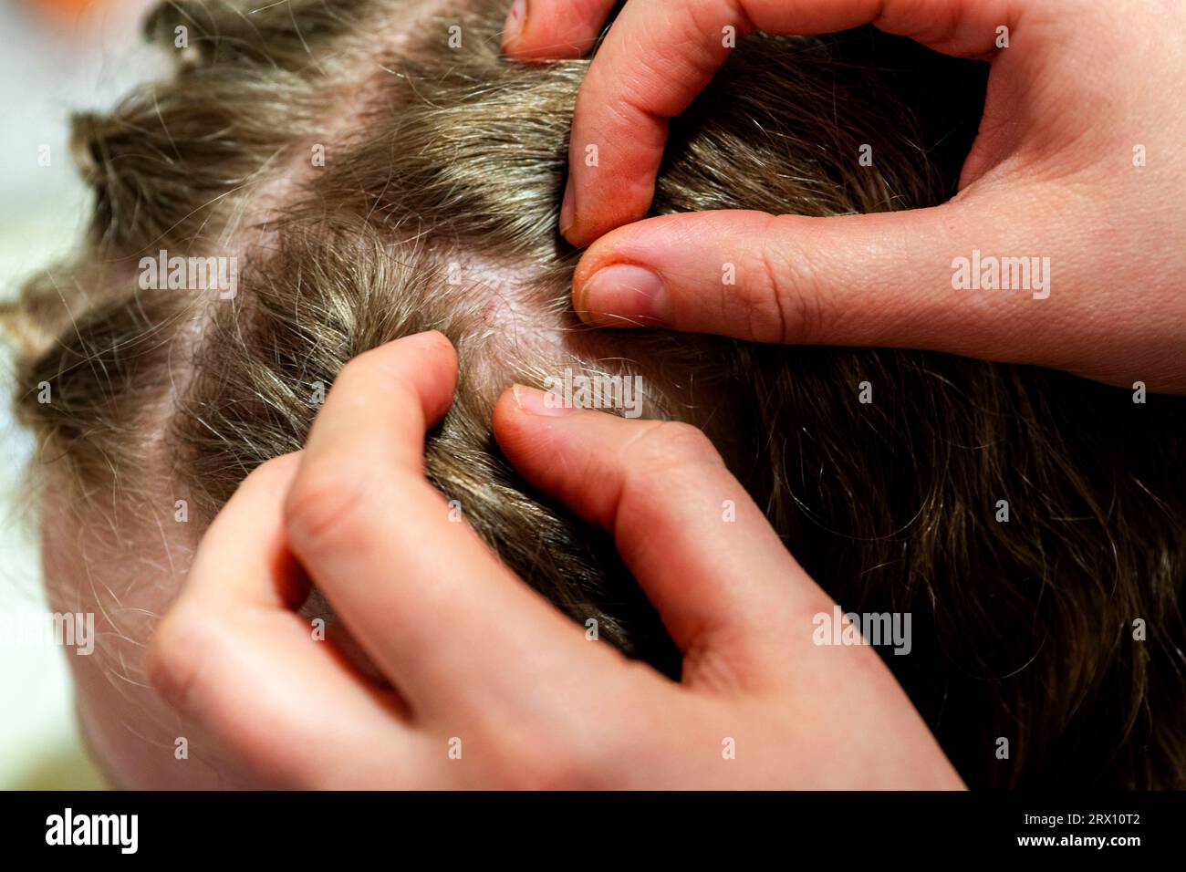 louse on head a little girl. Mother checking childs head for lice ...