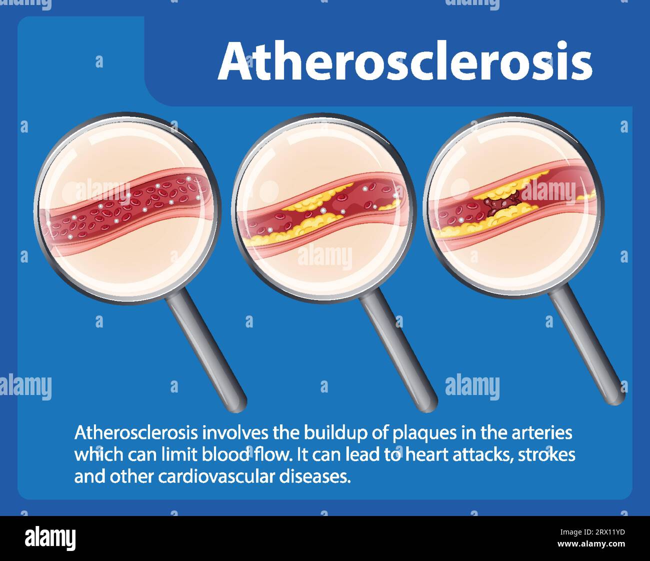 Infographic on heart health and cardiovascular disease risks Stock ...