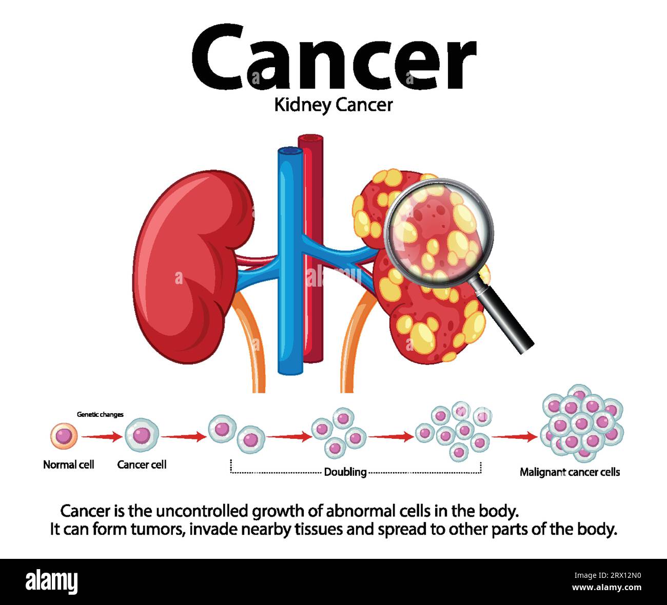 Kidney cancer cells Stock Vector Images - Alamy