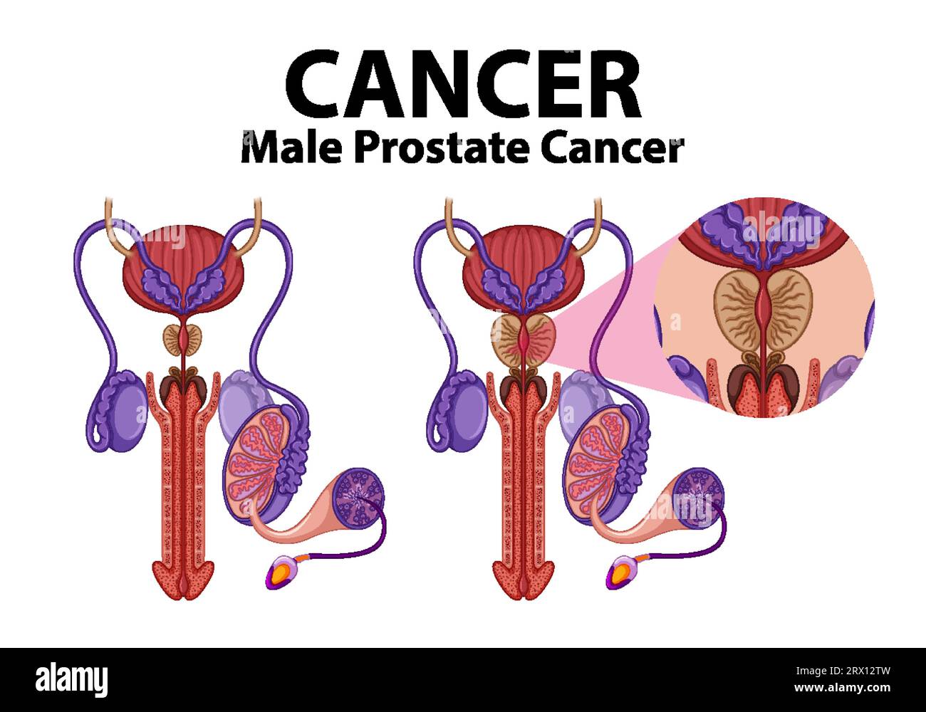 Illustrated infographic highlighting differences between healthy and cancerous prostate Stock ...