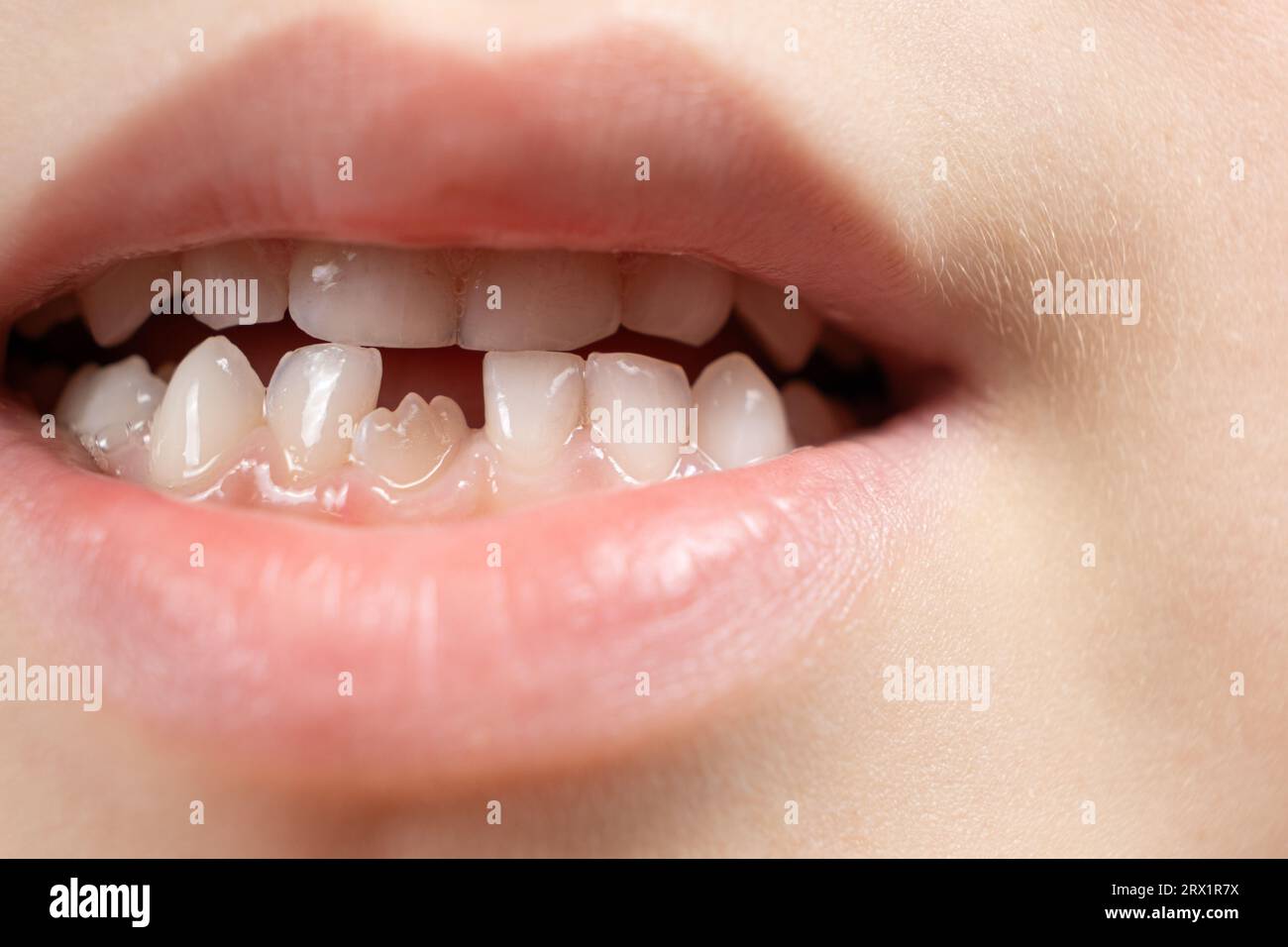 The teeth of a six-year-old child, a crookedly growing incisor in place ...
