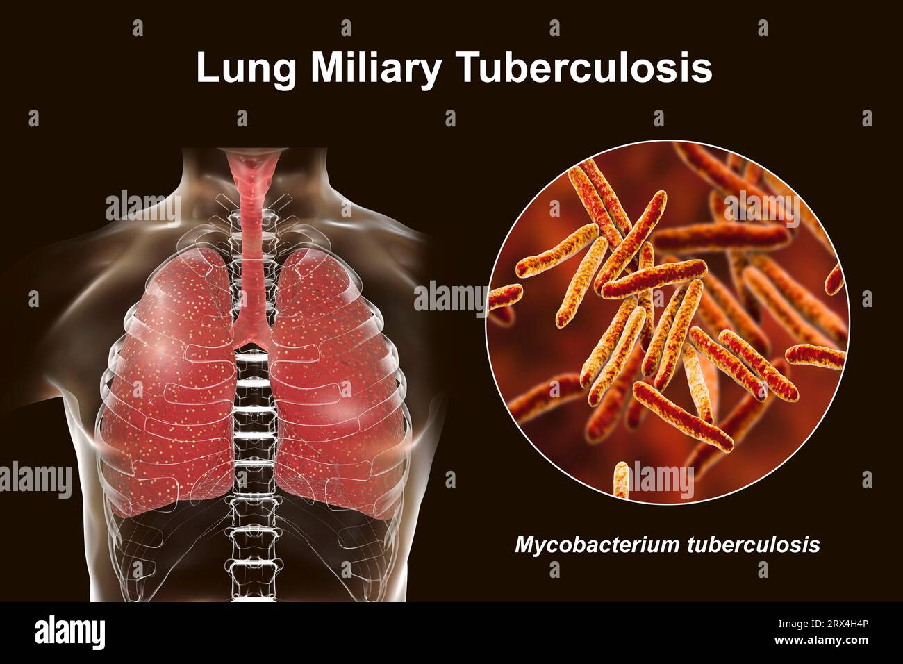 Lungs affected by miliary tuberculosis, illustration Stock Photo - Alamy