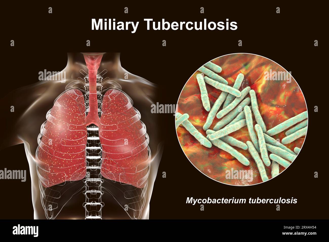 Lungs affected by miliary tuberculosis, illustration Stock Photo - Alamy
