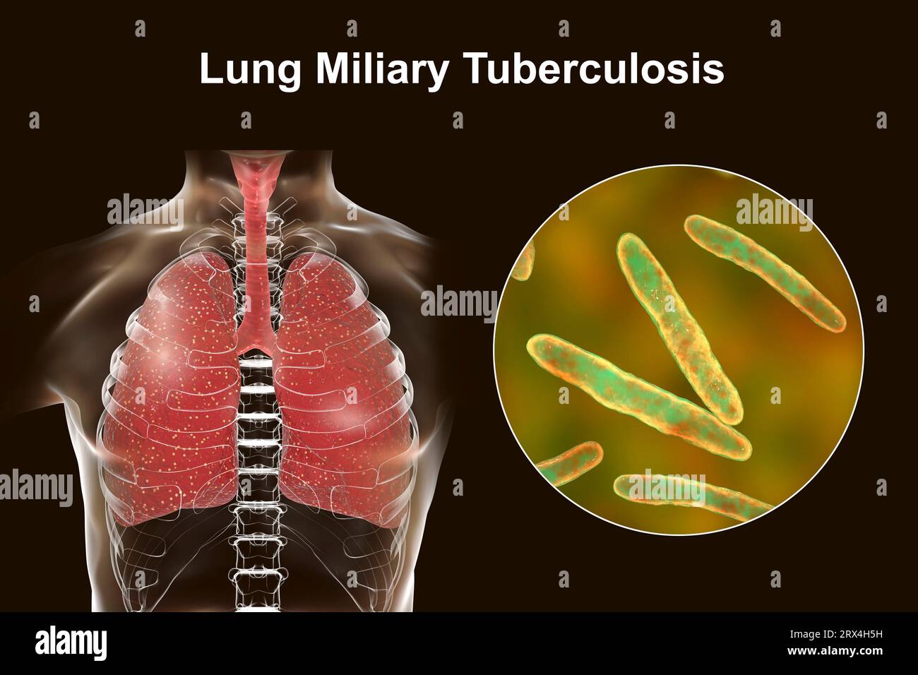 Lungs affected by miliary tuberculosis, illustration Stock Photo - Alamy