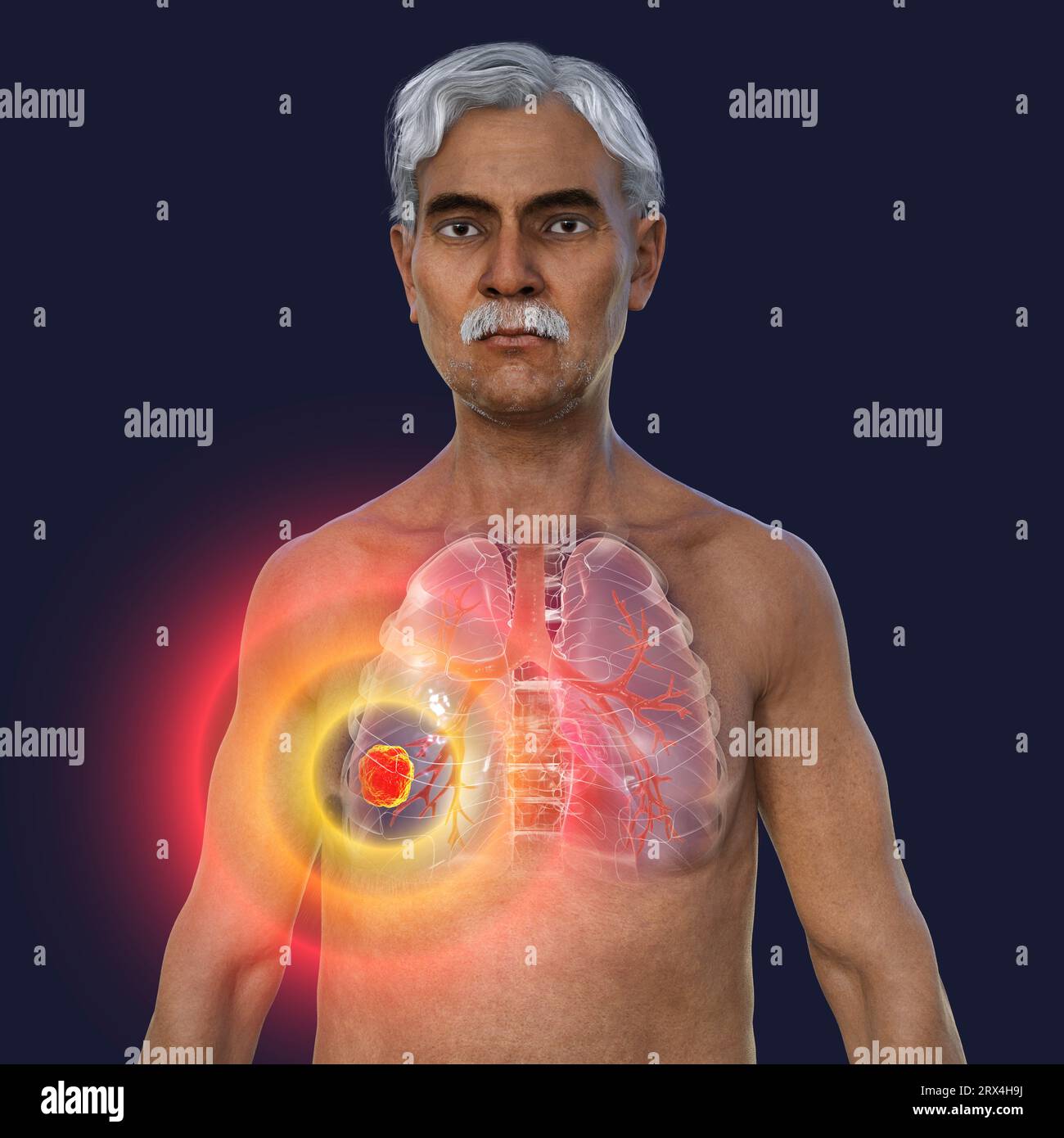 Lungs anatomy cancer hi-res stock photography and images - Alamy