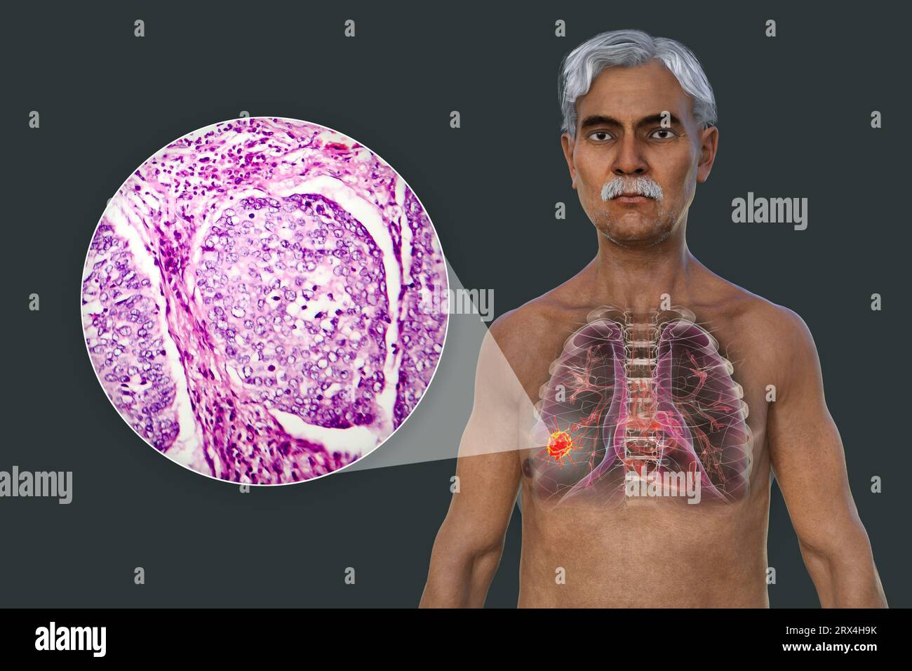Lungs affected by lung cancer, illustration Stock Photo - Alamy