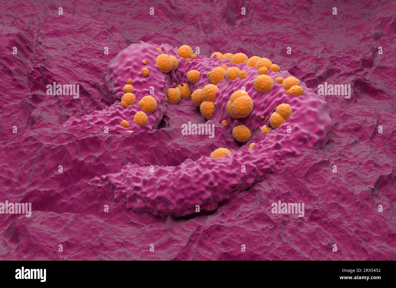 Basal-cell carcinoma (BCC) - isometric view 3d illustration Stock Photo ...