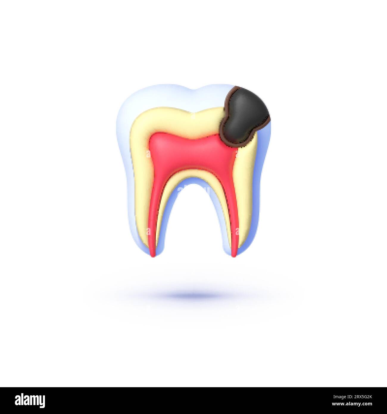 Tooth caries in 3d style. 3d vector isolated icon. Vector illustration ...