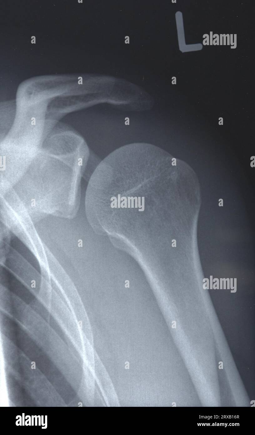 Shoulder joint, X-ray Stock Photo - Alamy