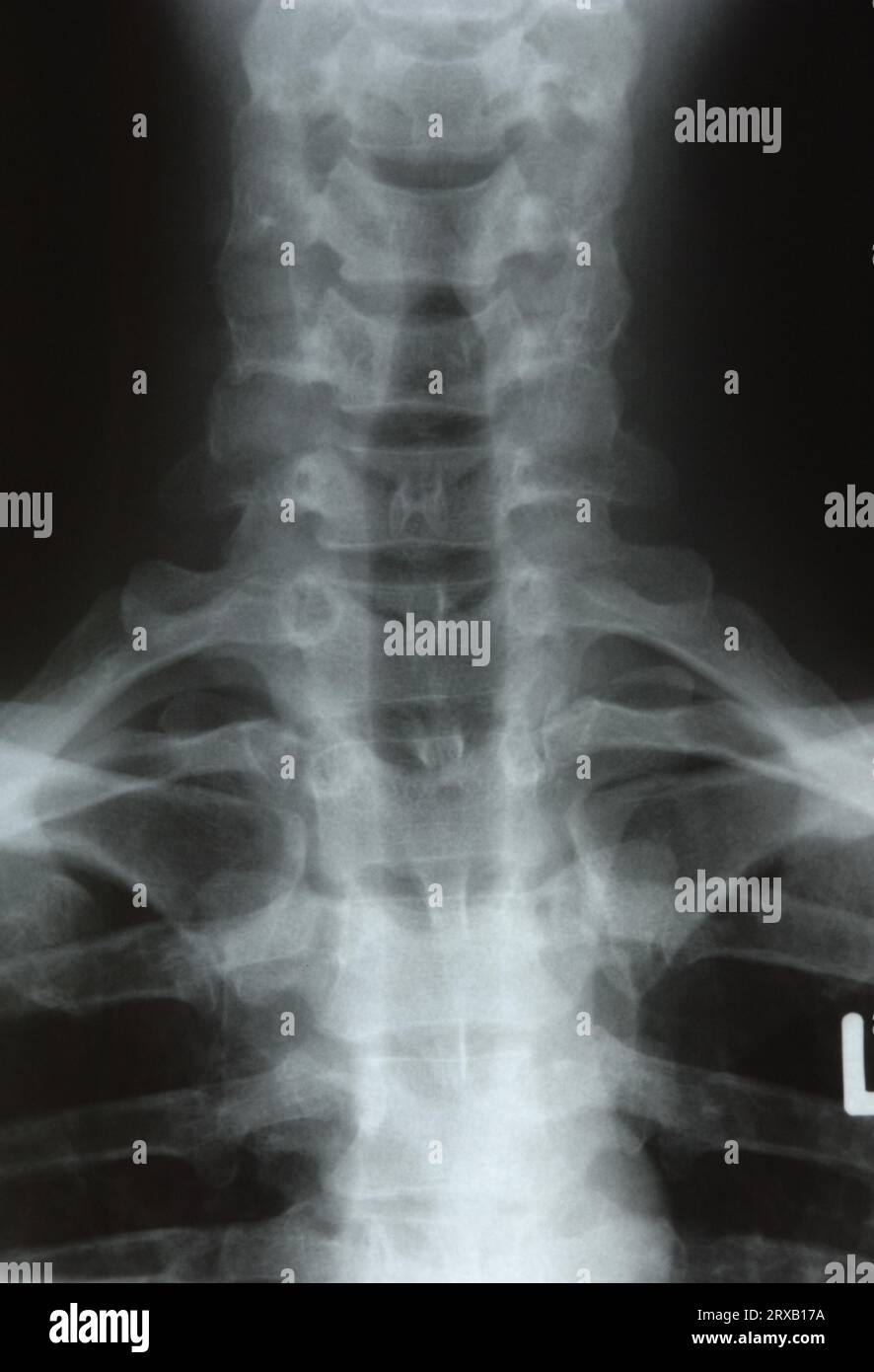 Cervical control hi-res stock photography and images - Alamy