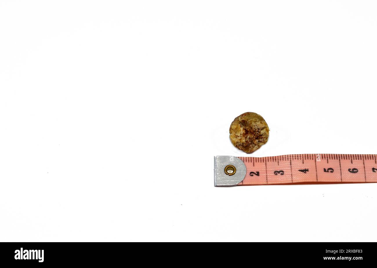 Large gallstone removed surgically after laparoscopic cholecystectomy ...