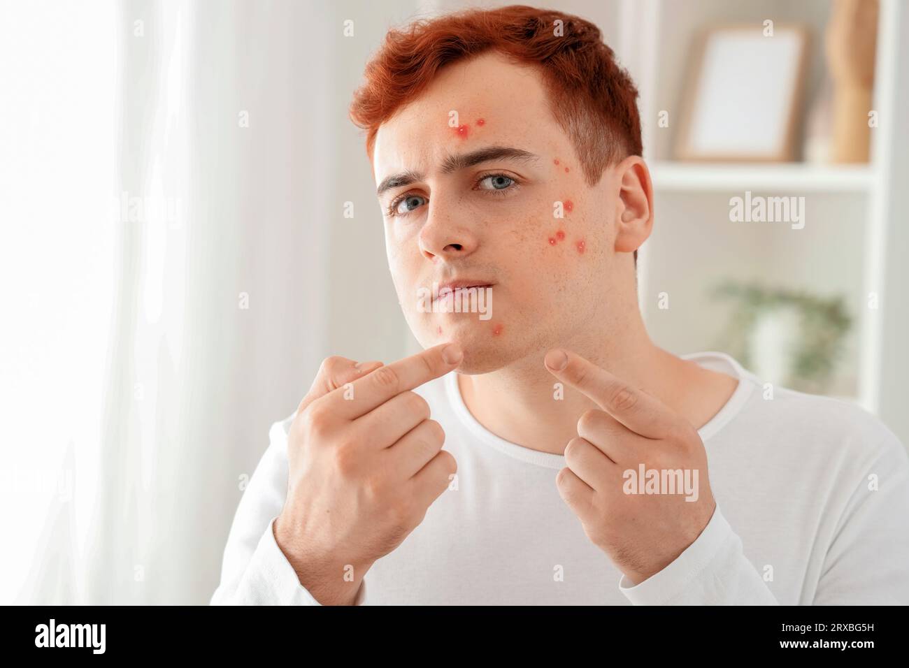 Teenage boy with acne squishing pimples in bathroom Stock Photo - Alamy