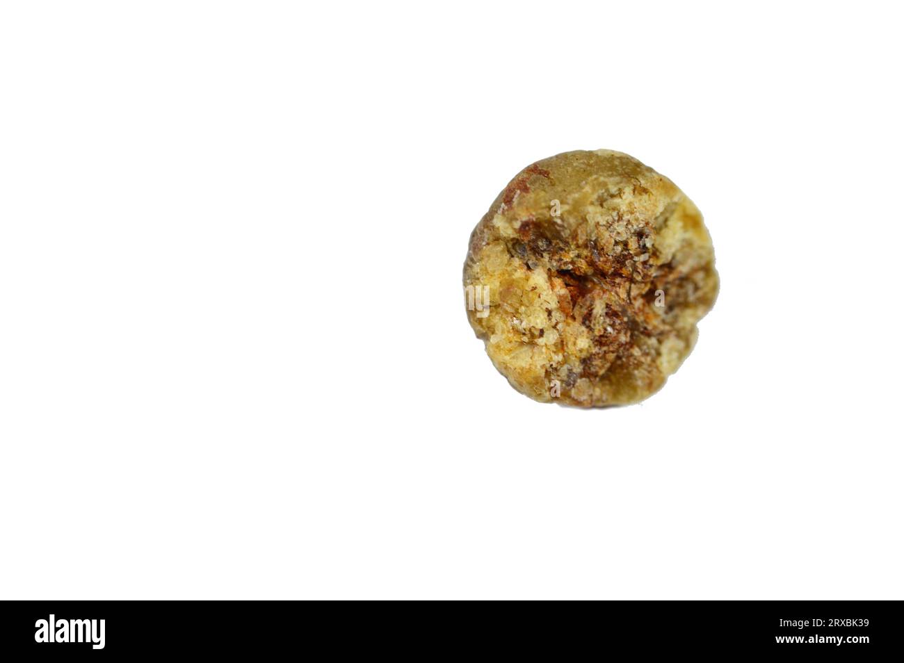 Large gallstone removed surgically after laparoscopic cholecystectomy ...