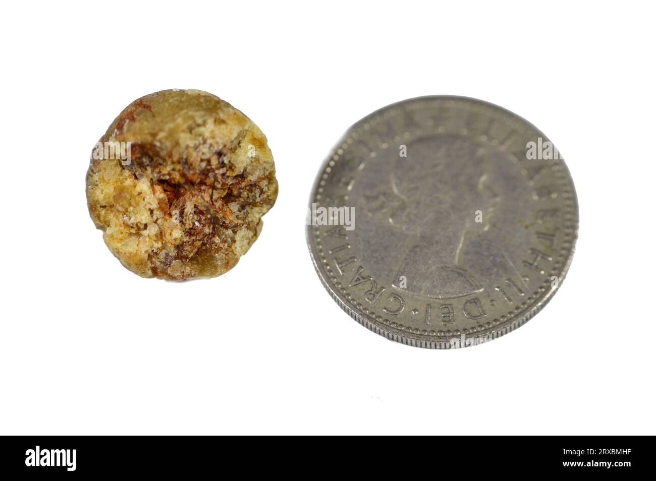 Large gallstone removed surgically after laparoscopic cholecystectomy ...