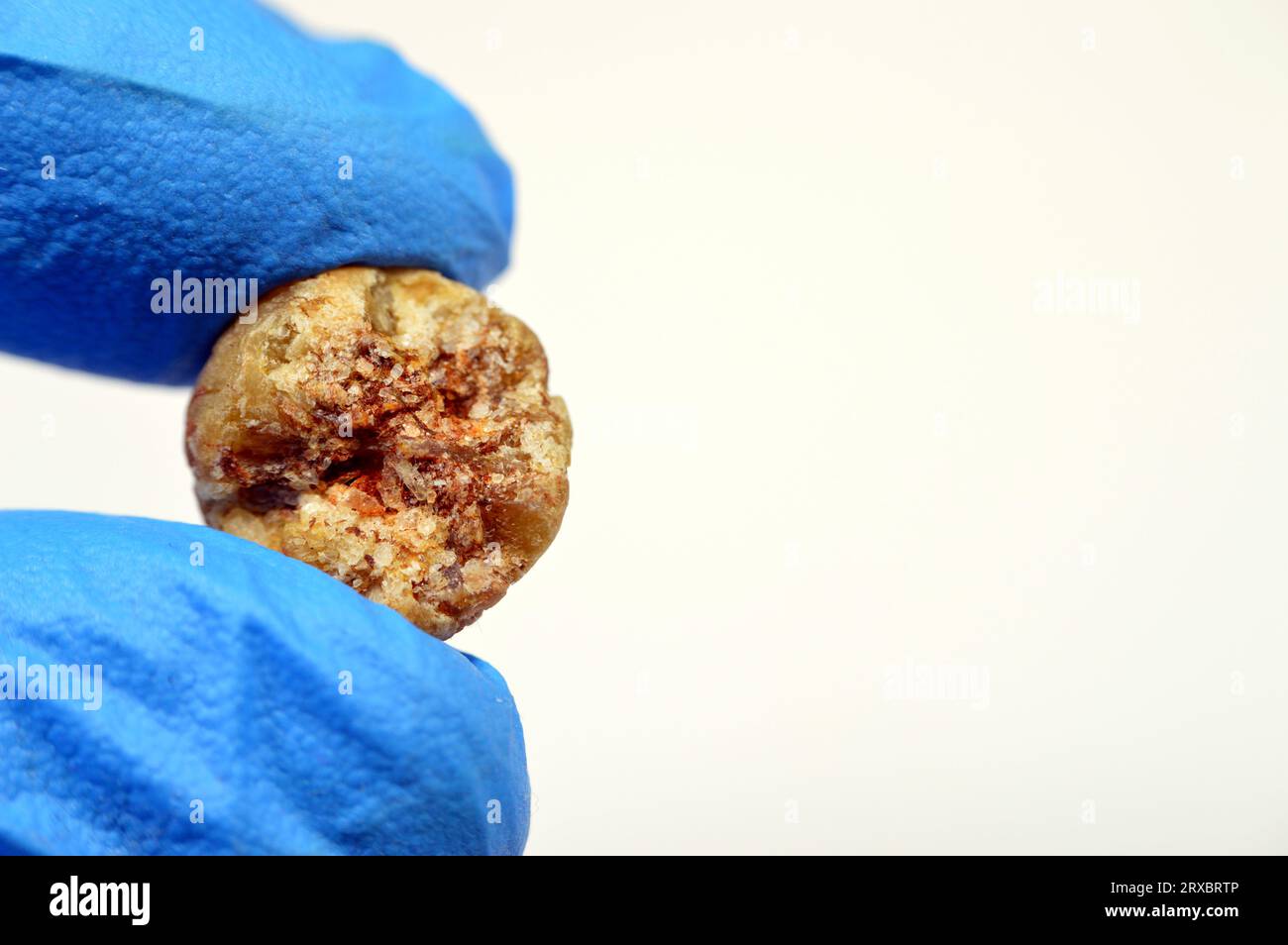 Gallstones hi-res stock photography and images - Alamy