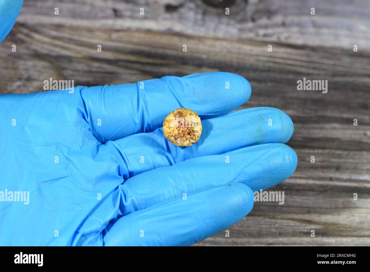 Large gallstone removed surgically after laparoscopic cholecystectomy ...