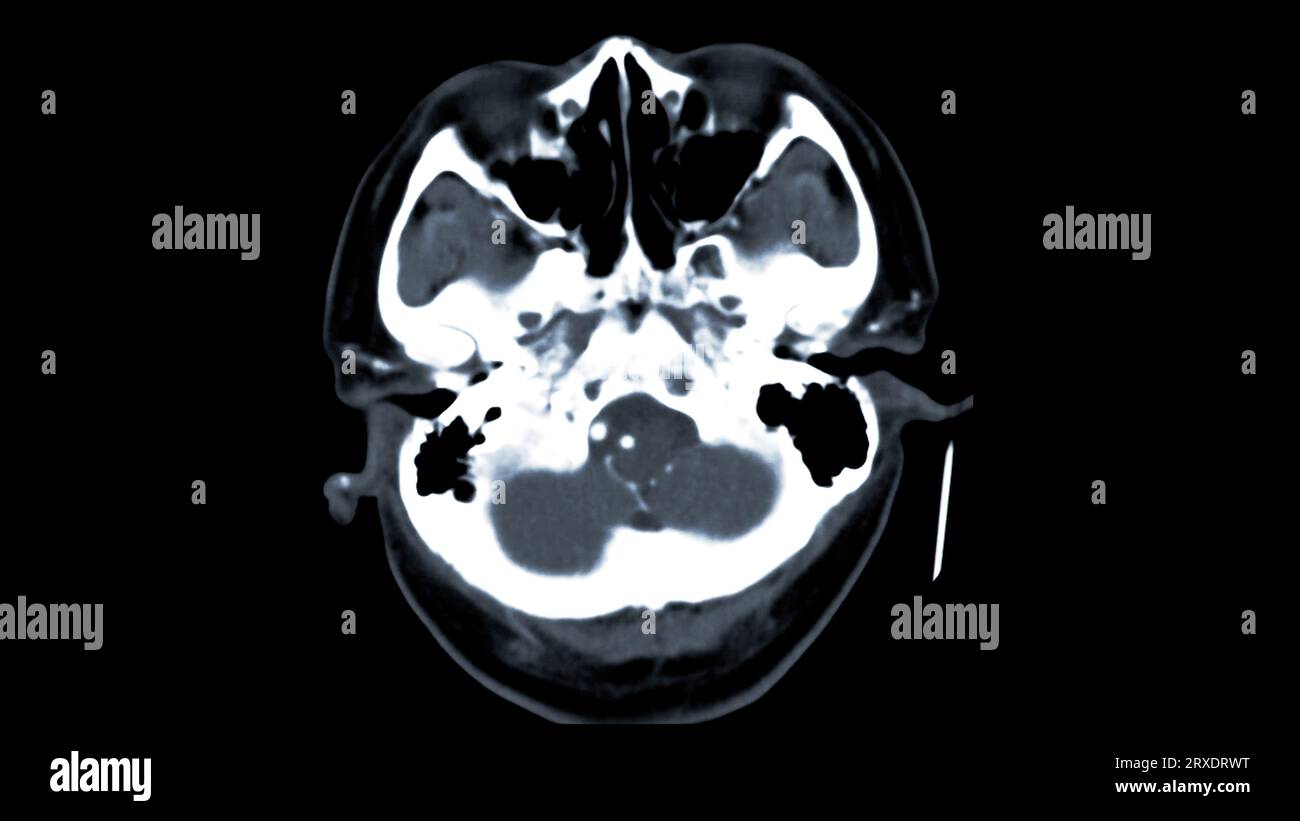CT scan of the brain with injection contrast media for diagnosis brain ...