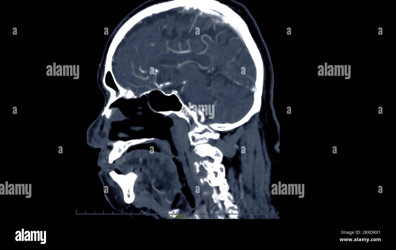 CT scan of the brain with injection contrast media for diagnosis brain ...