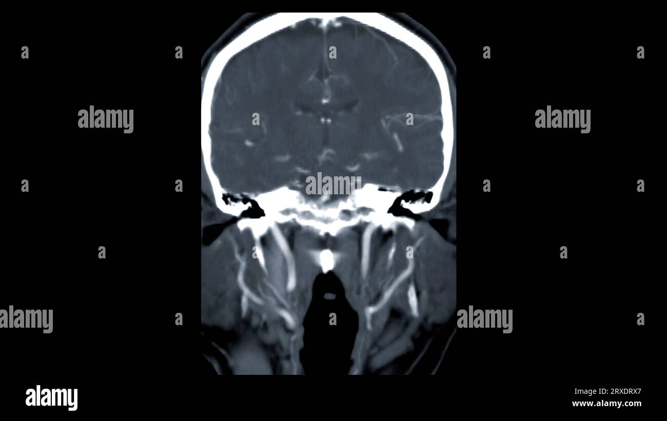 CT scan of the brain with injection contrast media for diagnosis brain ...